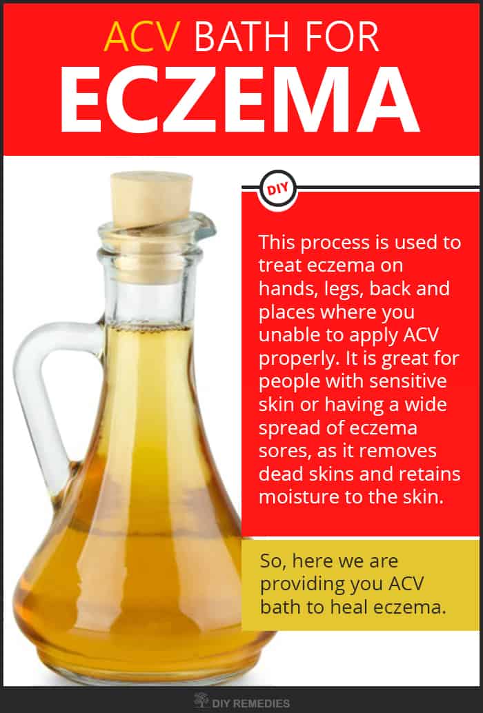 How to Get Rid of Eczema using Apple Cider Vinegar