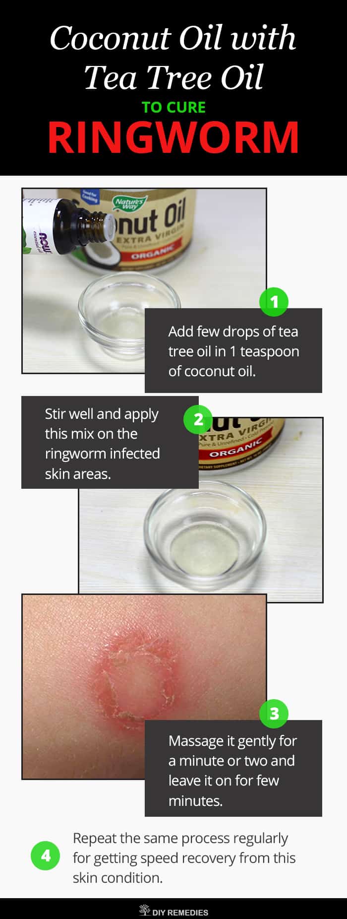 How to Cure Ringworm using Coconut Oil