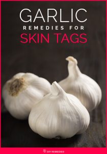 DIY Garlic Remedies for Skin Tags