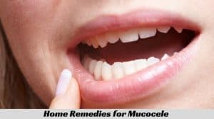 How to Get Rid of Mucocele (Mucous Cyst)