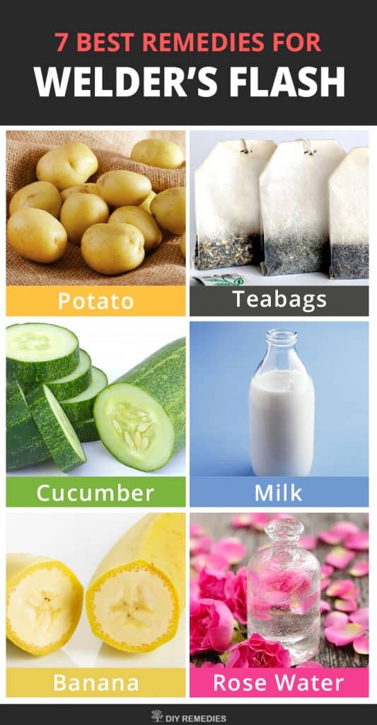 7 Best Remedies for Welder’s Flash